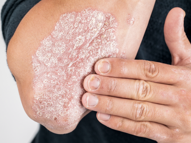 Když psoriáza zasáhne ruce a chodidla - Revmatické nemoci